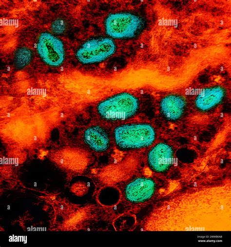 Colorized Transmission Electron Micrograph Of Monkeypox Virus Particles