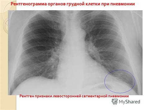 Рентген Легких У Ребенка Норма Фото —