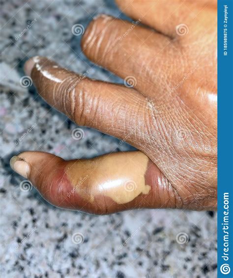 Abscess With Surrounding Cellulitis Or Staphylococcal Skin Infection At Little Finger Of Left