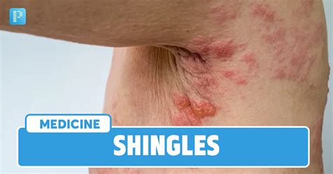 Shingles Symptoms And Treatment Understanding Shingles Herpes