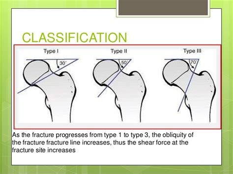 Nof Fracture