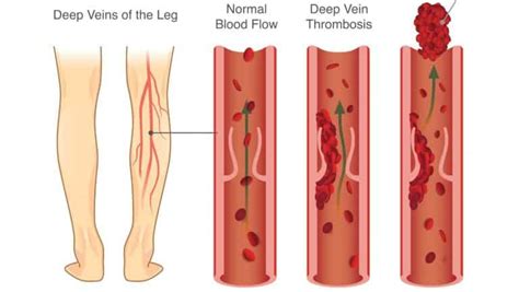 Bakers Cyst Massage Is Massage Good For Bakers Cyst