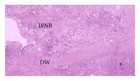 Micrographs Ac Intraductal Papillary Lesions A Intrahepatic Bile