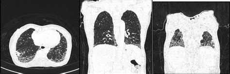 Hrct Chest Of The Patient Showed Honeycombing Picture With Reticular Download Scientific
