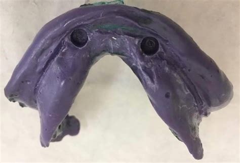 Model Obtained From Functional Casting With Polyether Download