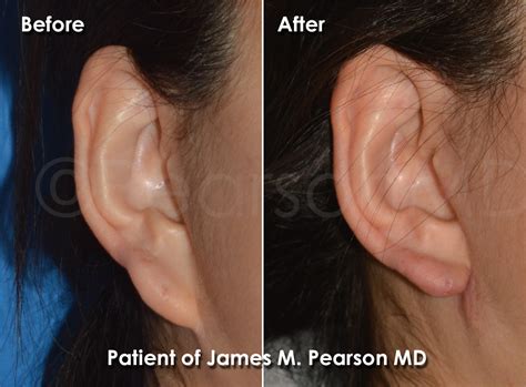 Pixie Ear Lobe Repair Photos Dr James Pearson Facial Plastic Surgery