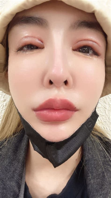 雪碧驚爆腫成豬頭！情色教主臉歪嘴斜「超驚悚照流出」網嚇：像被家暴