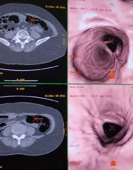 Virtual Colonoscopy Ct Colonography Fv Hospital