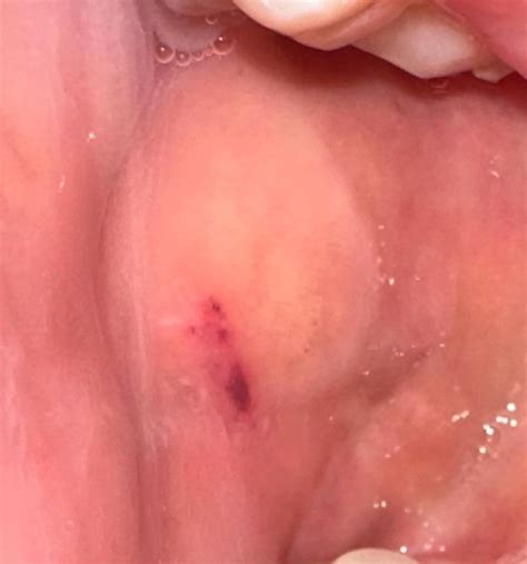 Chronic Ebv Mouth Skin Rash R Ebv