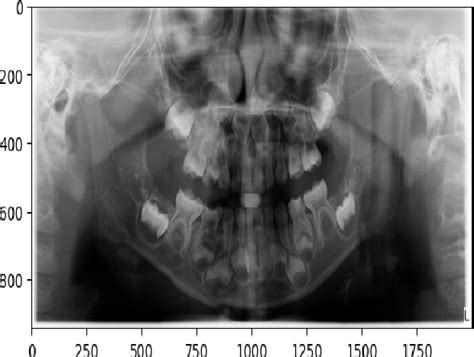 Figure 4 From Fast R Cnn Approaches For Transforming Dental Caries