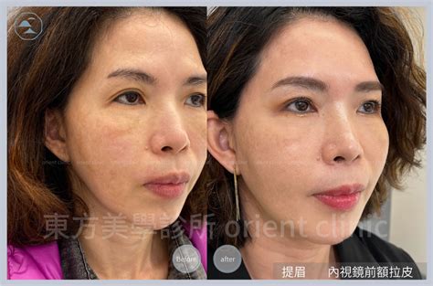 案例 內視鏡提眉術 東方美學診所 Orient Oculofacial Clinic