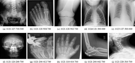 Medical Image Classification Via Svm Using Lbp Features From Saliency