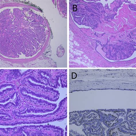 Papillary Dcis A With Microinvasion Cribriform Architecture Is