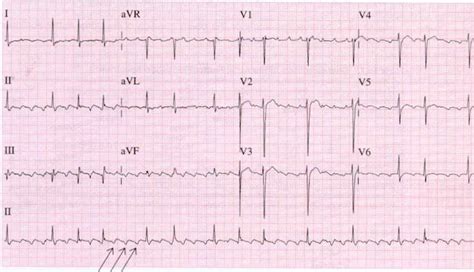Mengetahui Atrial Flutter Belajar Ekg