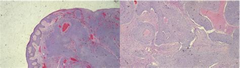 Histological Sections Showing Porocarcinoma Download Scientific Diagram