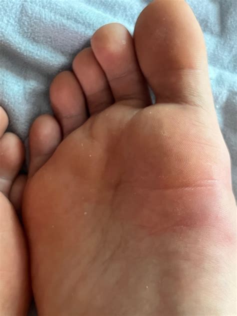 무좀이 맞나요 지식in