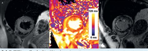 Figure 1 From Cardiac Mri T2 Mapping Versus T2 Weighted Dark Blood Tse