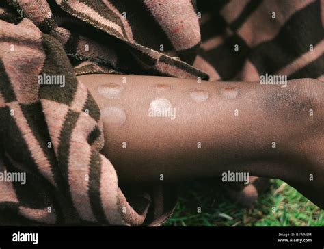 Thigh Of Maasai Moran Warrior Showing Scars On Leg Caused By Burns To