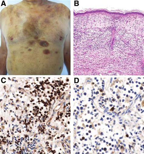 Clinical Appearance And Histological Features Of Pdcl Skin Lesions