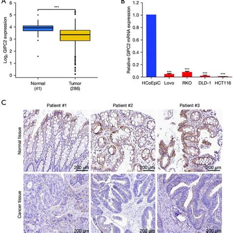 Gipc2 Is Downregulated In Human Crc Tissues And Cells A Box Plot