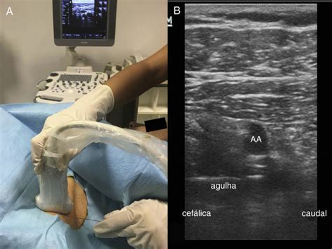Abordagem Retroclavicular Para O Bloqueio Do Plexo Braquial Por Via Download Scientific Diagram