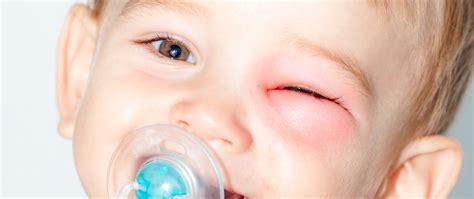 Bee Sting First Aid How To Treat And Soothe Uk