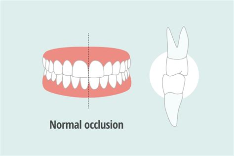 Underbite Vs Overbite Whats The Difference And How Are They Treated Hawley Orthodontics