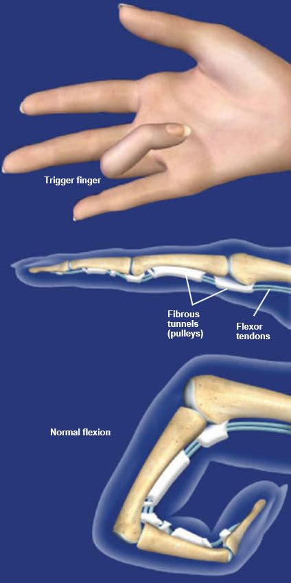 Stenosing Tenosynovitis Pismo Beach Trigger Digit Santa Maria