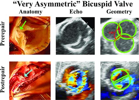 Pre And Postrepair Views Of Valve Anatomy Echocardiography Echo And