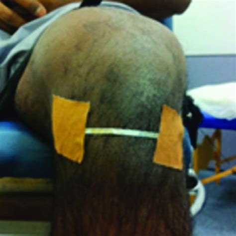 Placement Of The Echo Absorptive Marker Download Scientific Diagram