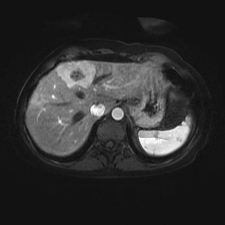 Hepatic Peliosis Radiology Reference Article Radiopaedia Org Radiology Radiology Imaging