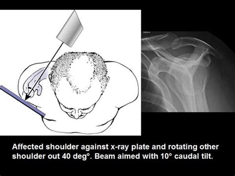 Outlet View Of Shoulder Joint X Ray Paul Smith