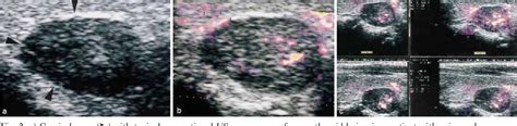 Figure 1 From Contrast Enhanced Color Doppler Ultrasonography In