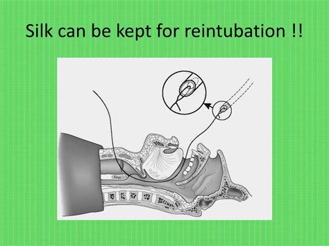 Ppt Retrograde Intubation Powerpoint Presentation Free Download Id 2240425
