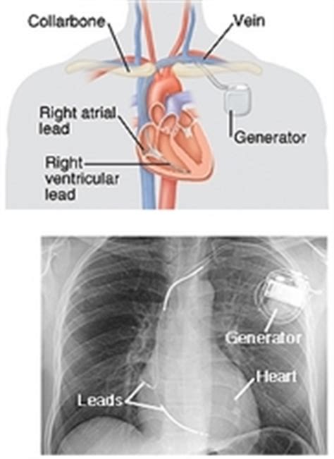 Implantable Cardioverter Defibrillator ICD Nevada Heart Vascular Center