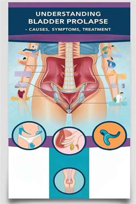 Understanding Bladder Prolapse Causes Symptoms Treatment Bladder