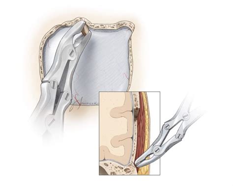 The Neurosurgical Atlas On Linkedin During Subtemporal Or Middle