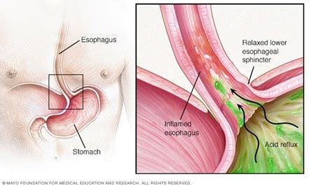 Heartburn Causes