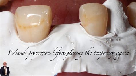 Management Of Type Iii Extraction Socket Way To Go Myzerodonto