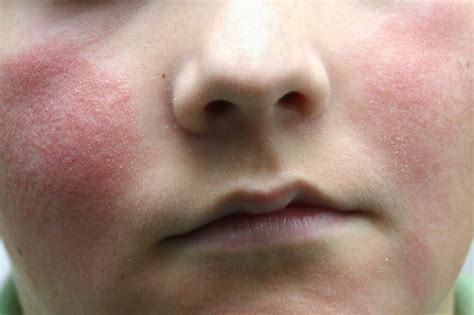Peta Osipna Bolest Erythema Infectiosum ZZJZKS