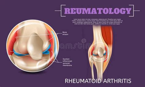 Rheumatoid Arthritis Of Cervical Spine Vector Stock Vector