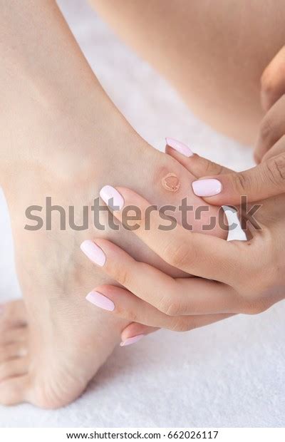 Female Feet Calluses Stock Photo 662026117 Shutterstock