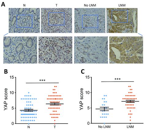 High Yap Protein Expression In Human Gc Notes A Yap Protein Level