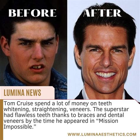 Tom Cruise Teeth Before After Braces