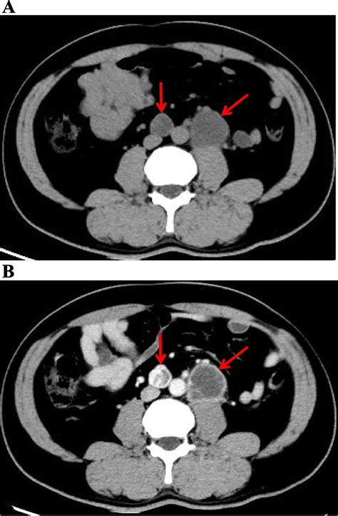 A And B Abdominal Computer Tomography Plain And Enhanced Scan Masses Download Scientific