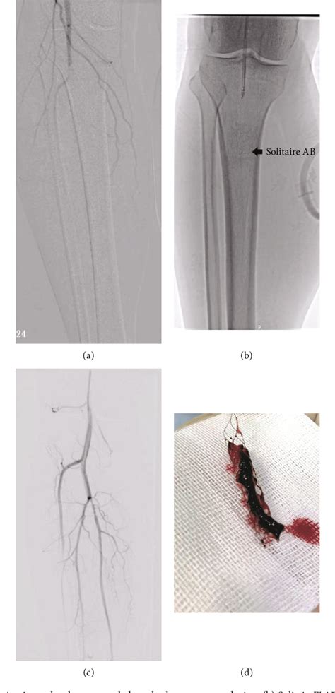 Figure 1 From Solitaire™ Stent Thrombectomy System In The Treatment Of Acute Lower Limb Ischemia