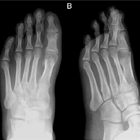Posterior Anterior X Ray Imaging Of The Left Forefoot Showing An