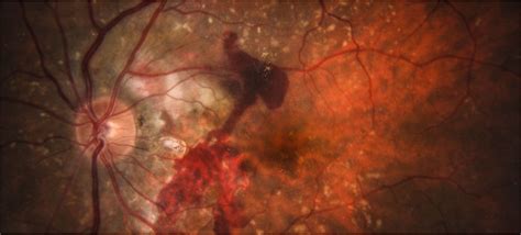 Degeneración Macular Clinicaderetina