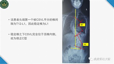 手把手教程：青少年特发性脊柱侧凸的lenke分型 好医术文章 好医术 赋能医生守护生命