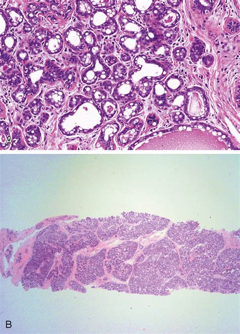 Fibroepithelial Lesions Clinical Tree